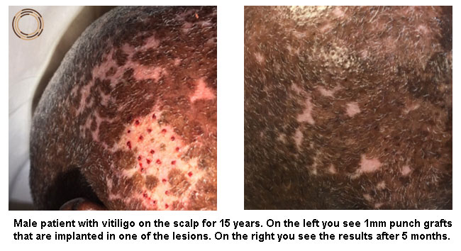 Vitiligo and melanocyte transplantation; learn about Vitiligo (white ...